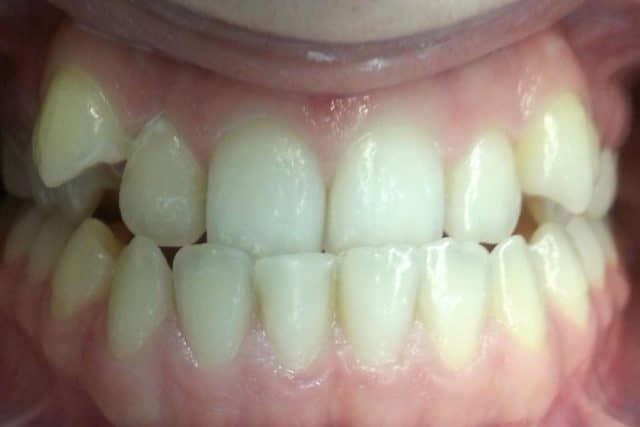 Corrección de la oclusión mesial ⋆ Odontología