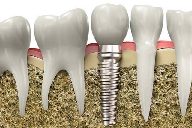 ¿Cómo restaurar un diente extraído? ⋆ Odontología