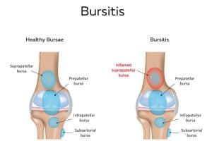 Bursitis de la articulación de la rodilla: síntomas, causas, tratamiento ⋆